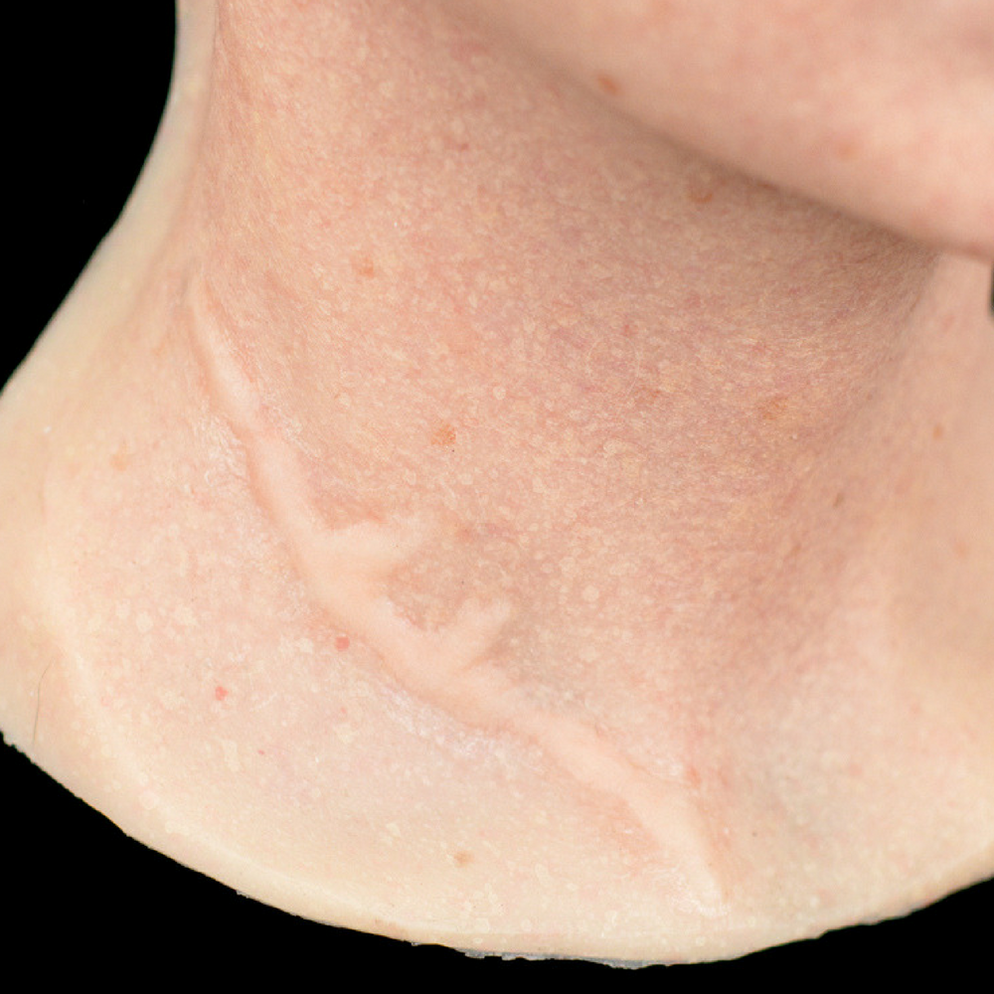 Out of Kit Split Keloid Scar — Frends Beauty